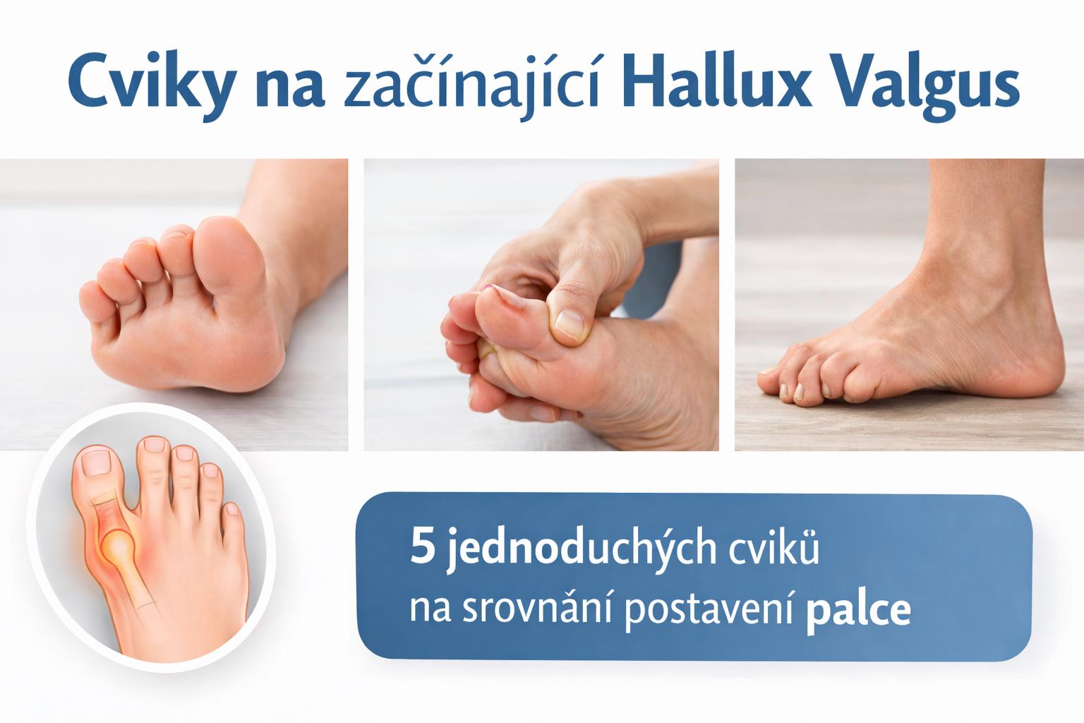 5 cviků na začínající hallux valgus - SPOKONOŽKA.cz